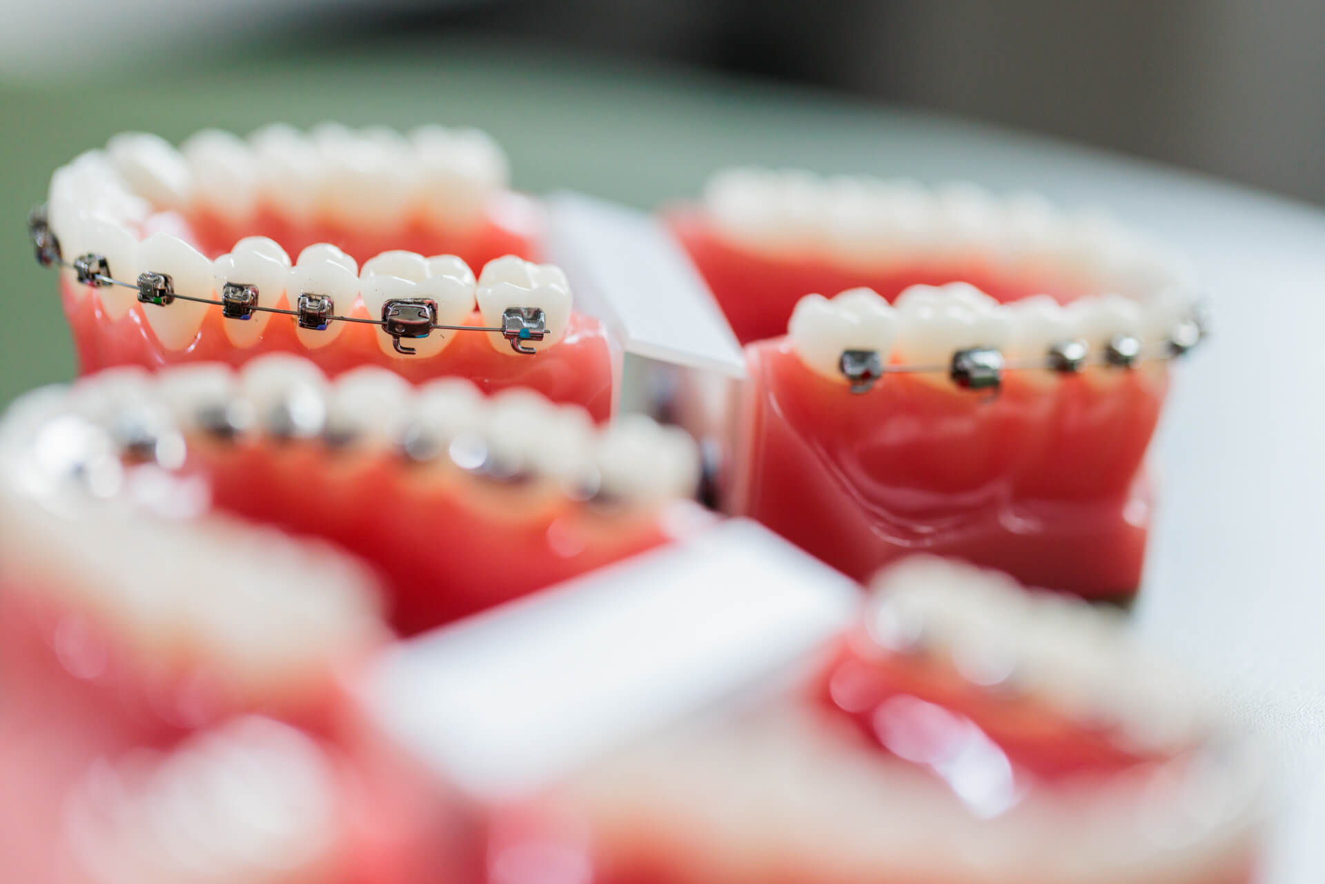 Feste Zahnspange — Kieferorthopädie Dr. Goteni